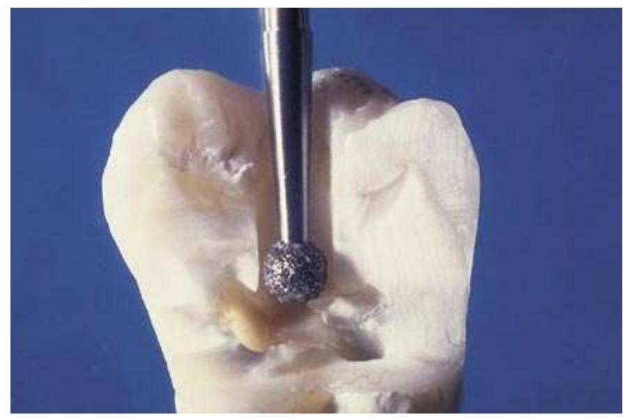 17. the penetration phase is completed. the diamond bur has