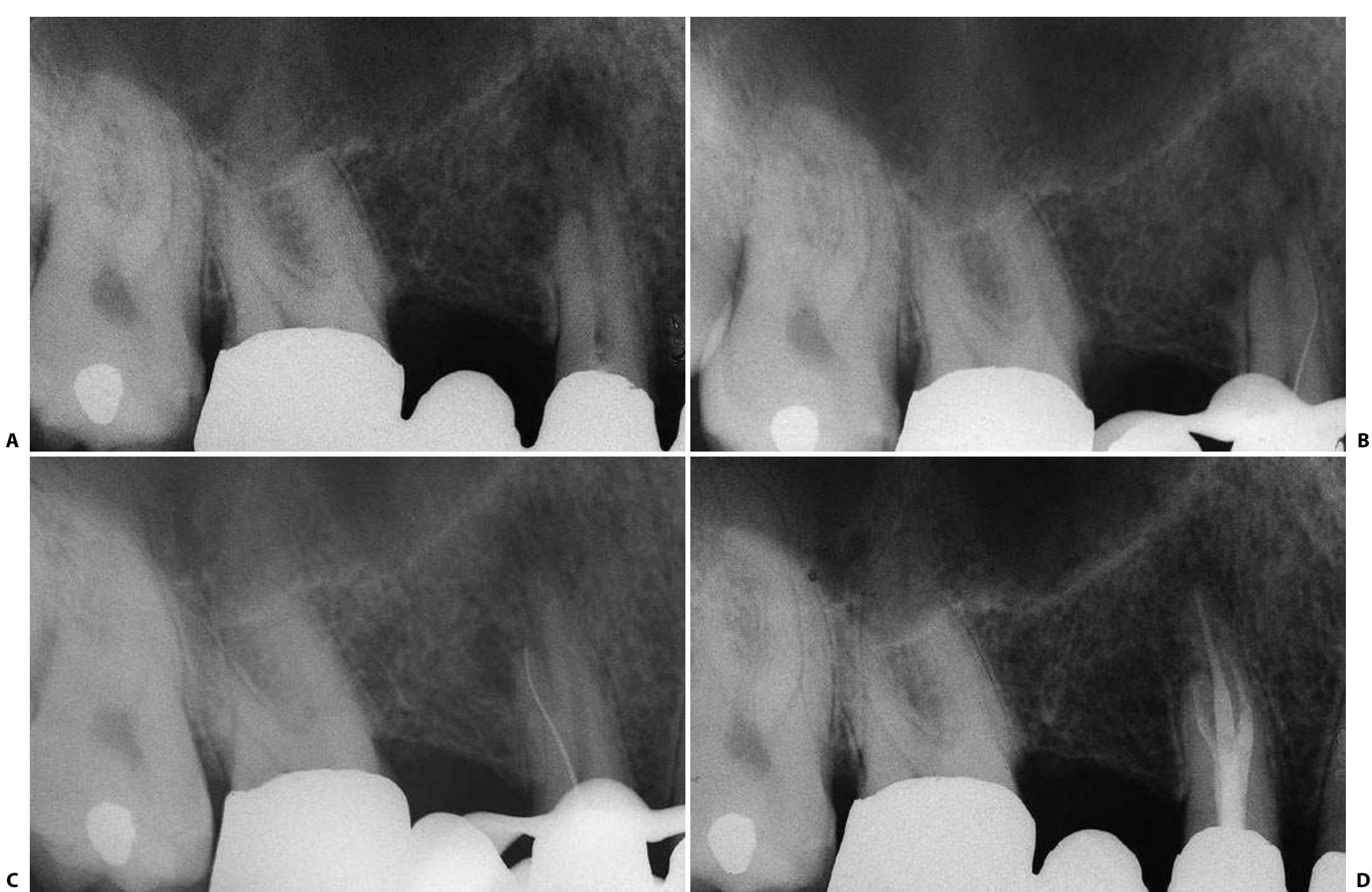 47.a. preoperative radiograph of an upper right first