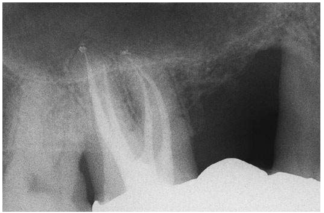 62. postoperative radiograph of an upper right first molar