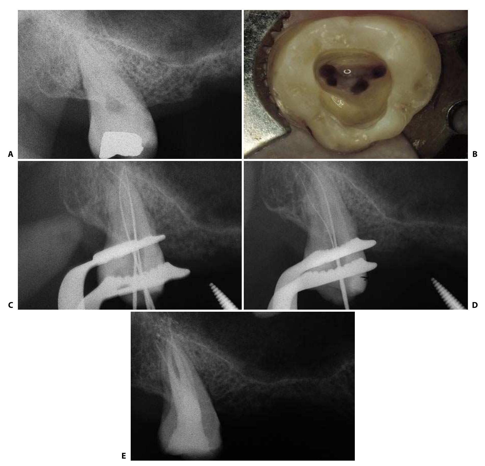 79. a. preoperative radiograph of the upper right third