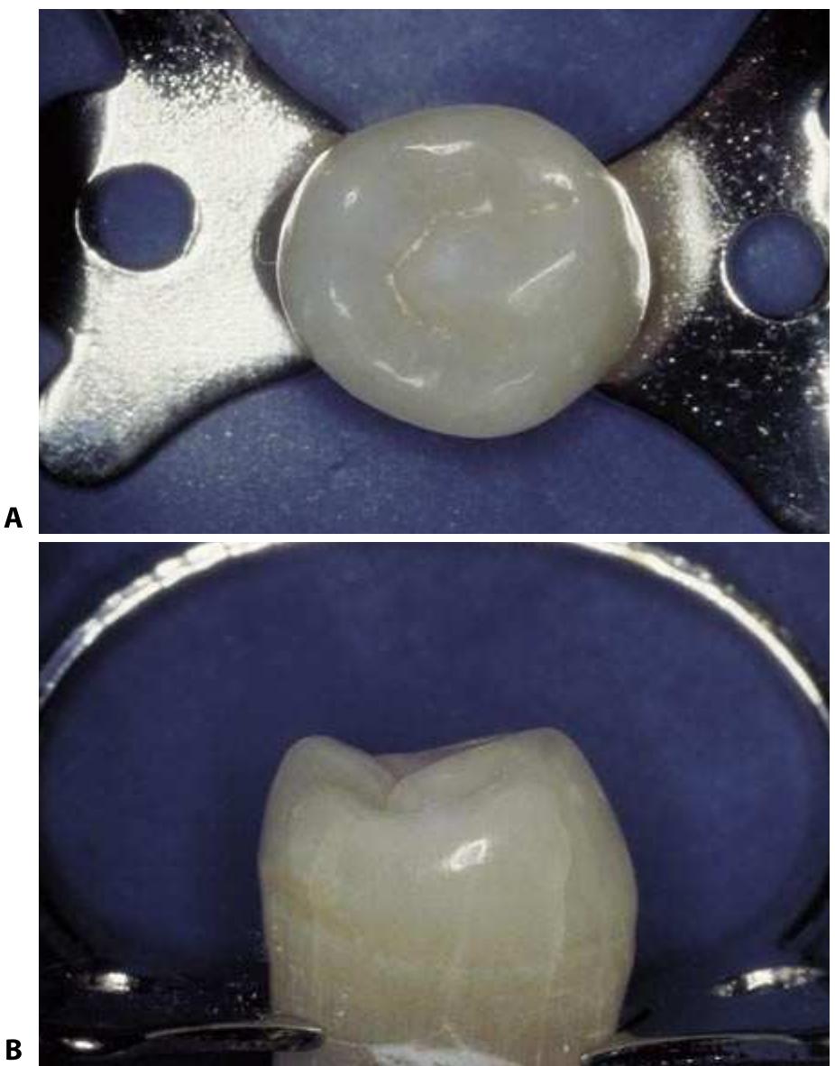 99. a. occlusal surface of the lower left second premolar.