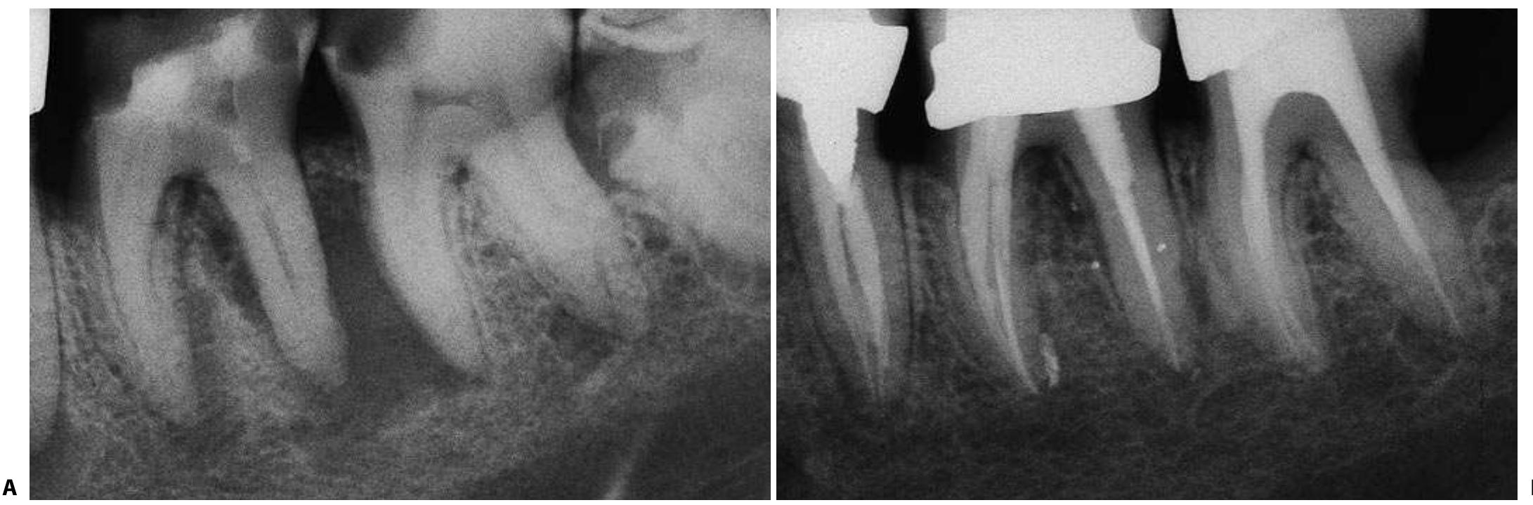 121.a lower second molar with one distal and two mesial