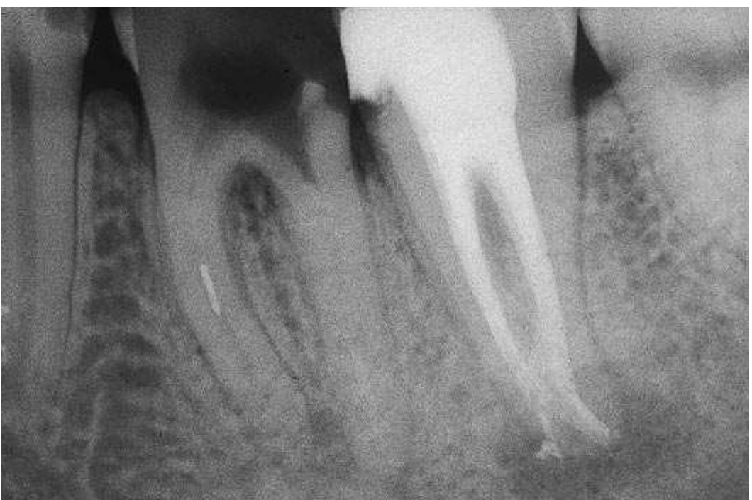 126. postoperative radiograph of a lower left second molar