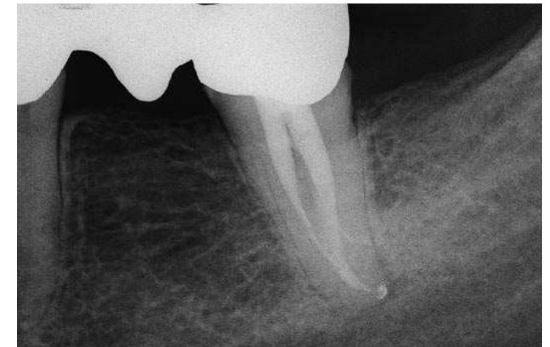127. postoperative radiograph of a lower left second molar