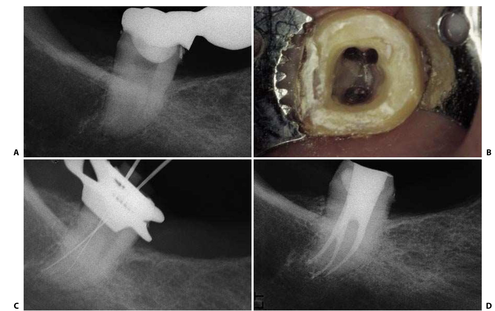 142. a lower third molar with two distal canals and a single