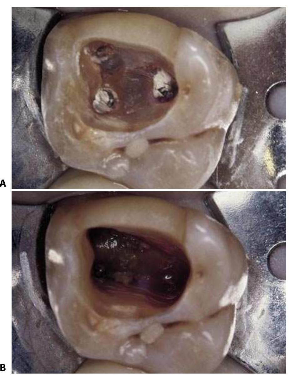 157. a. the root canal treatment of this upper first molar
