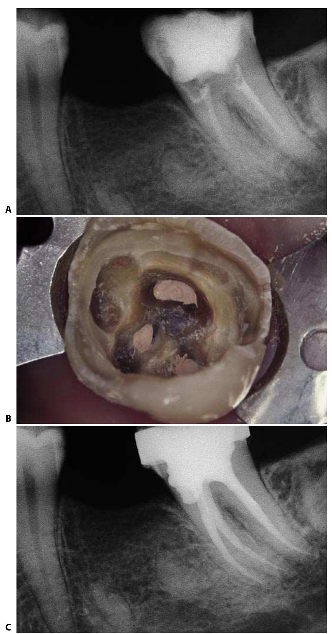 163.a lower left second molar with an endodontic anatomy of
