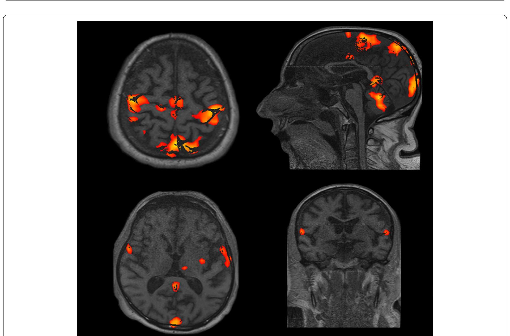 Fmri with 99% sensitivity during the 100 mamp electrical