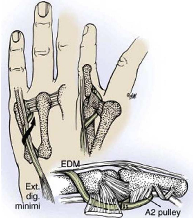 The ulnar slip of the extensor digiti minimi is passed deep