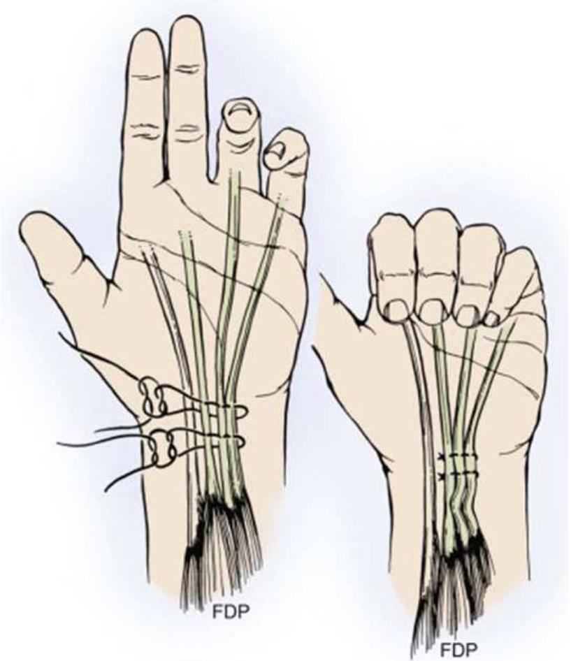 Tenodesis of the paralyzed ulnar-innervated flexor digitorum