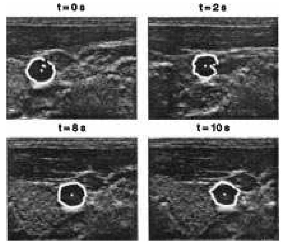 Tracking the carotid artery by the snake algorithm; the
