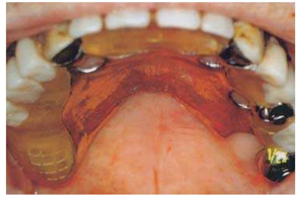 Denture stomatitis — induced by an old teeth prosthesis.