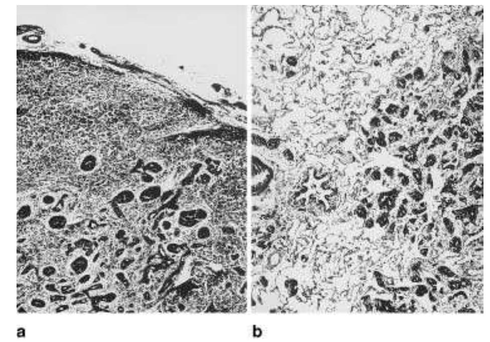 (a) axillary lymph node metastasis and infiltration of