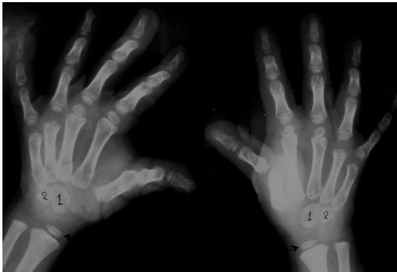 Plain x-ray of both hands shows marked delay in bone age