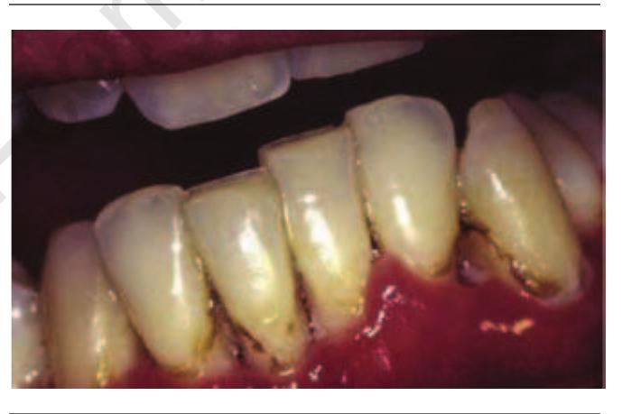 Oral hpv lesion.® reproduced with permission from ias-usa.