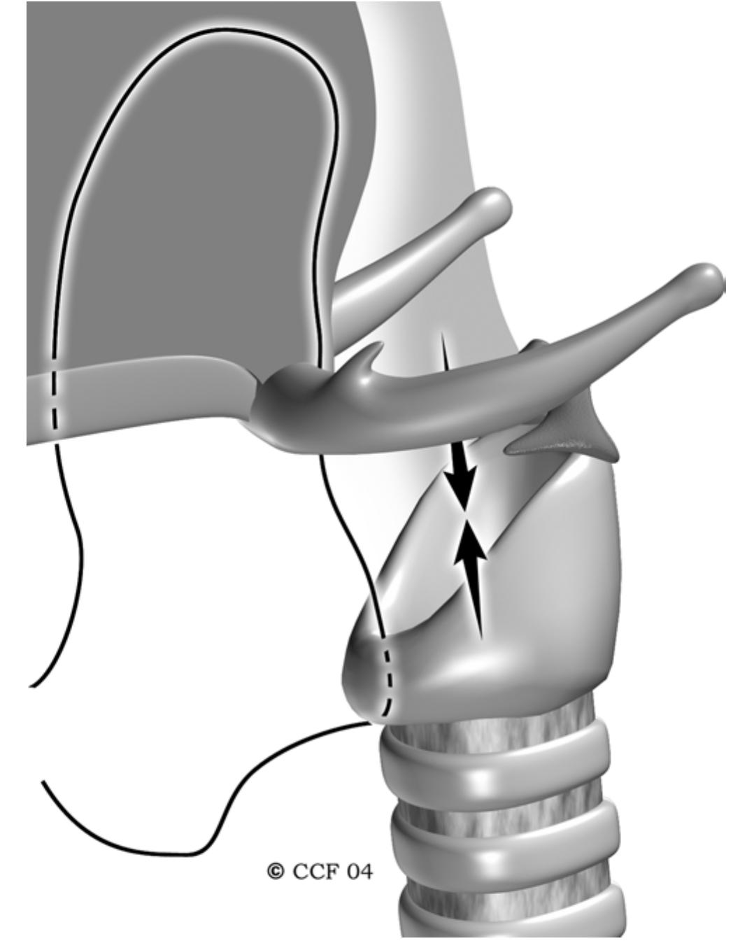 Whole epiglottis and preepiglottic space. preservation of