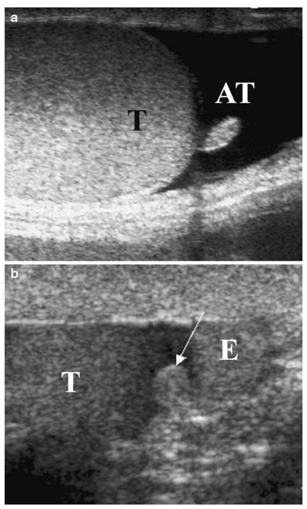 Figure 2 - Cystic appendix epididymis: a sonomorphologic