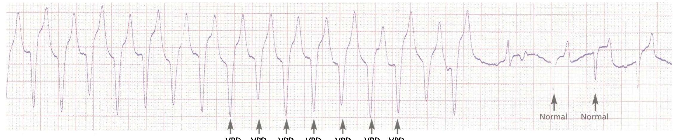 Ecg showing monomorphic ventricular tachycardia