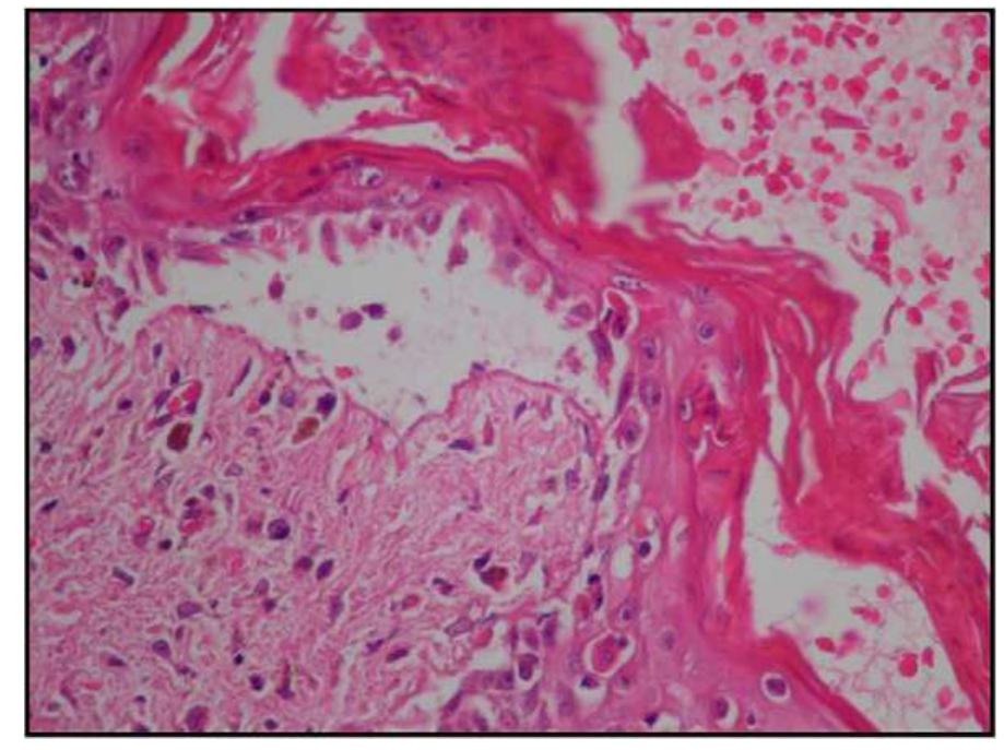 Skin biopsy showing grade iii gvhd (case 3).