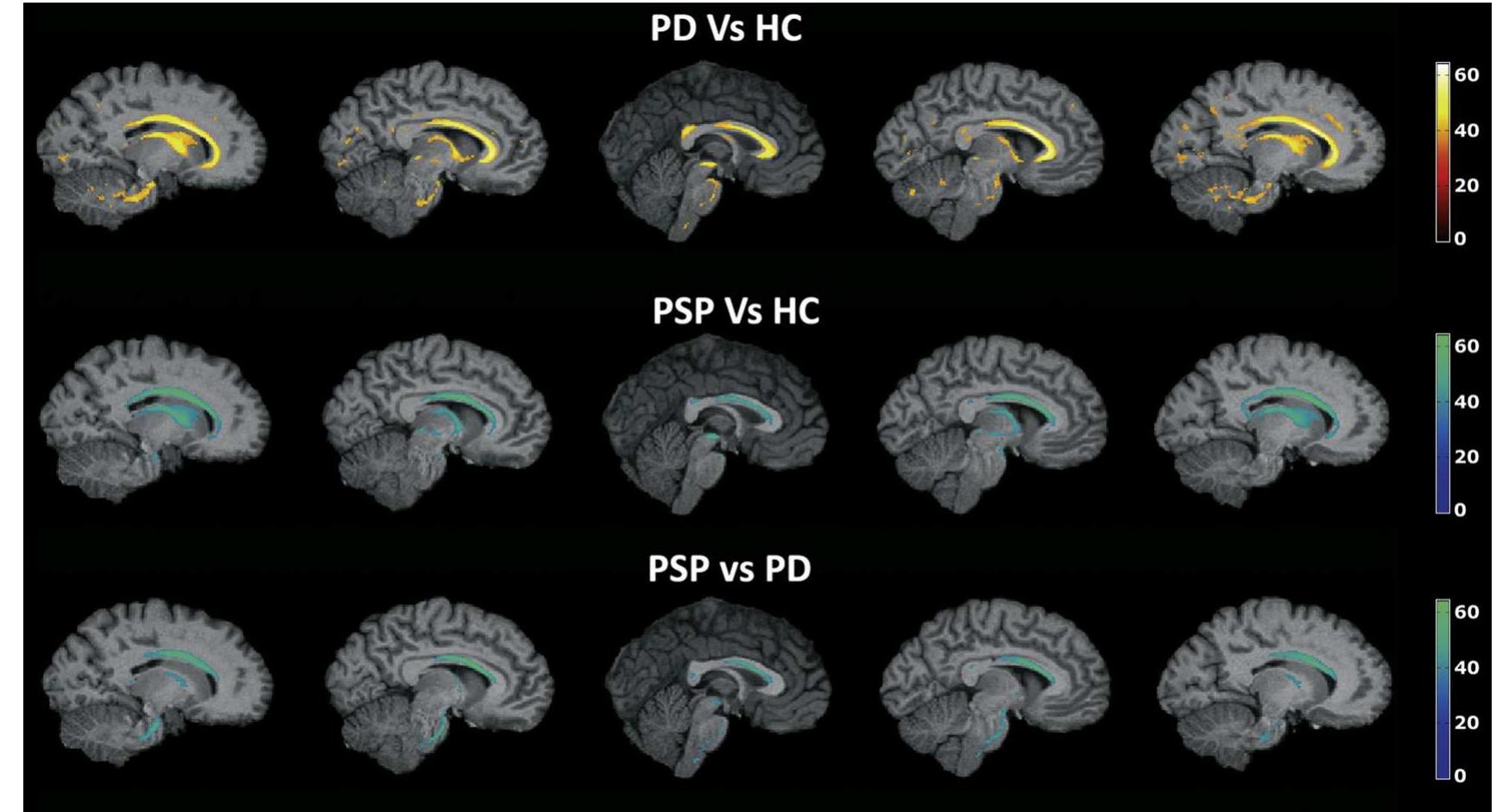 Maps of voxel-based pattern distribution of brain structural