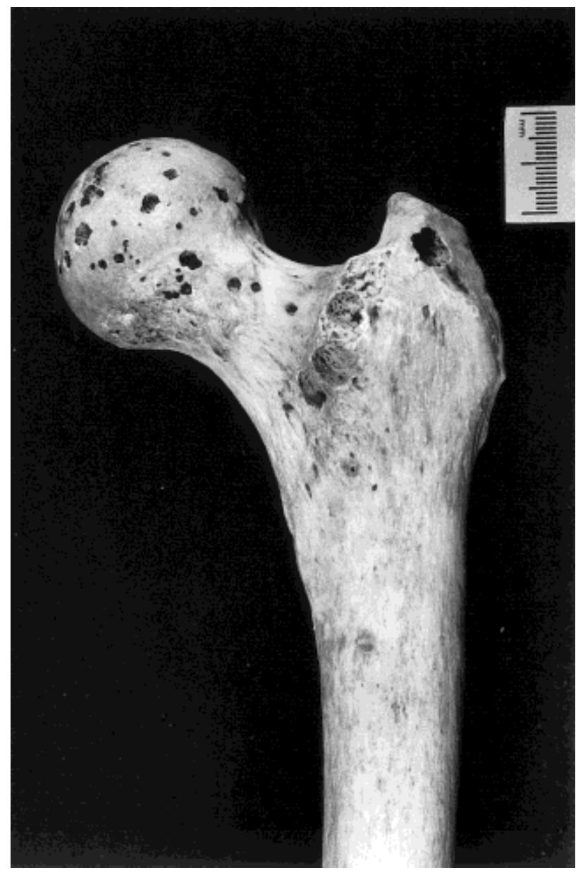 Anterior view of proximal femur (terry 787) affected by