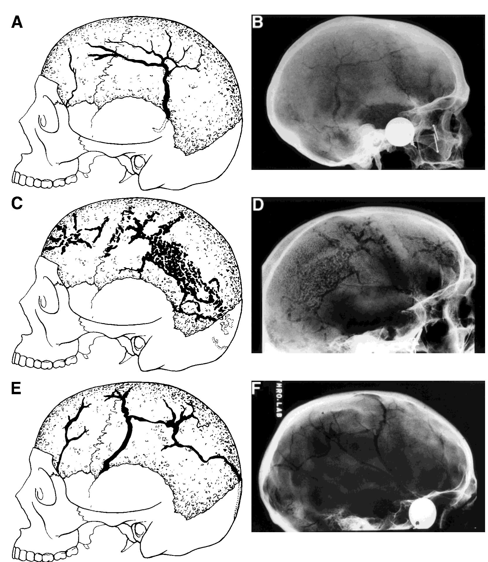 Lateral x-ray views and schematics of diploic vein patterns.