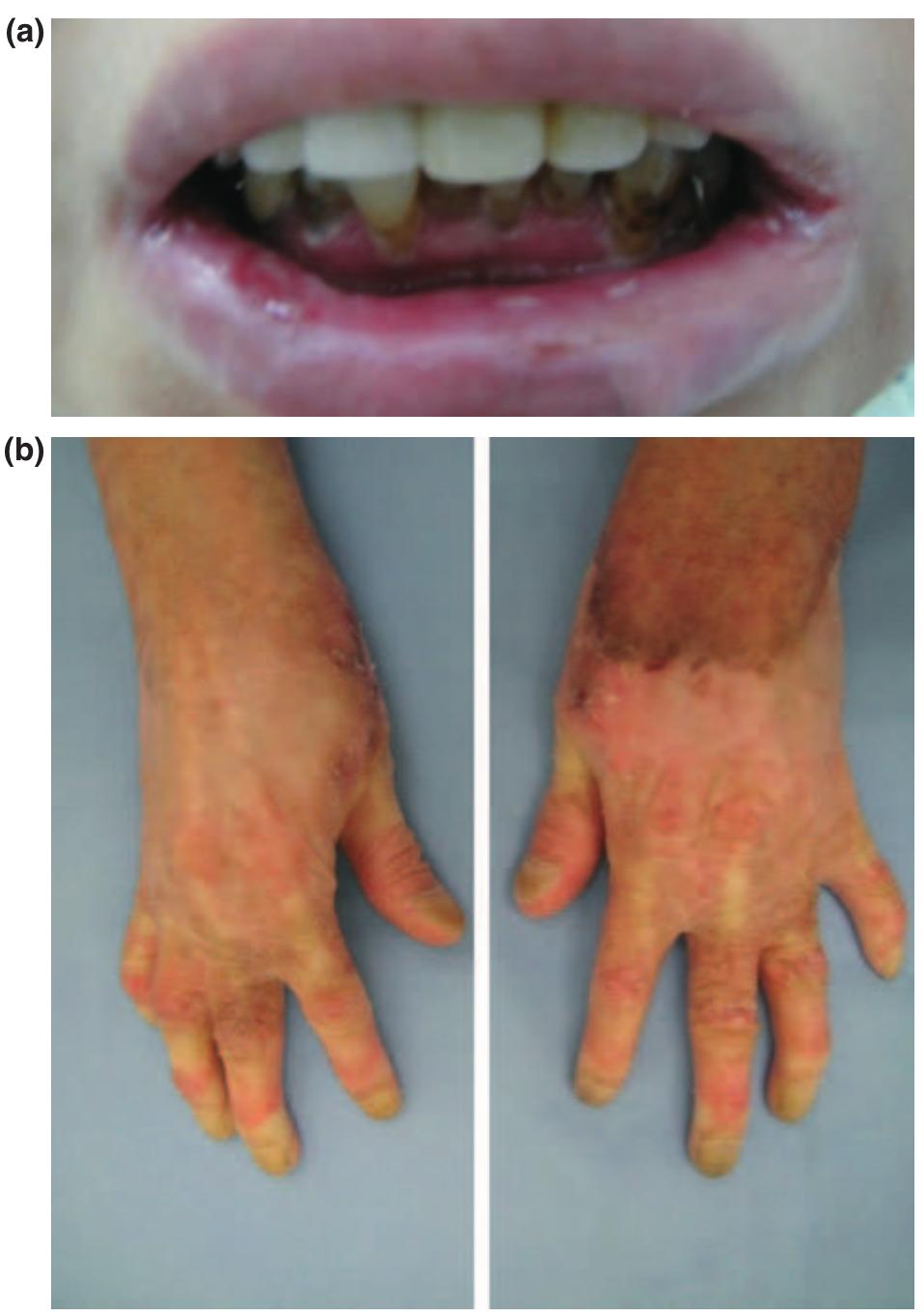 Clinical features of the patient. (a) erosion on the lip and