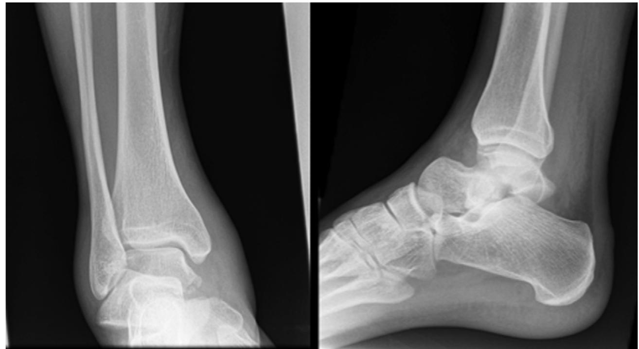 Ap and lateral x-rays of the ankle; note the appearance of a