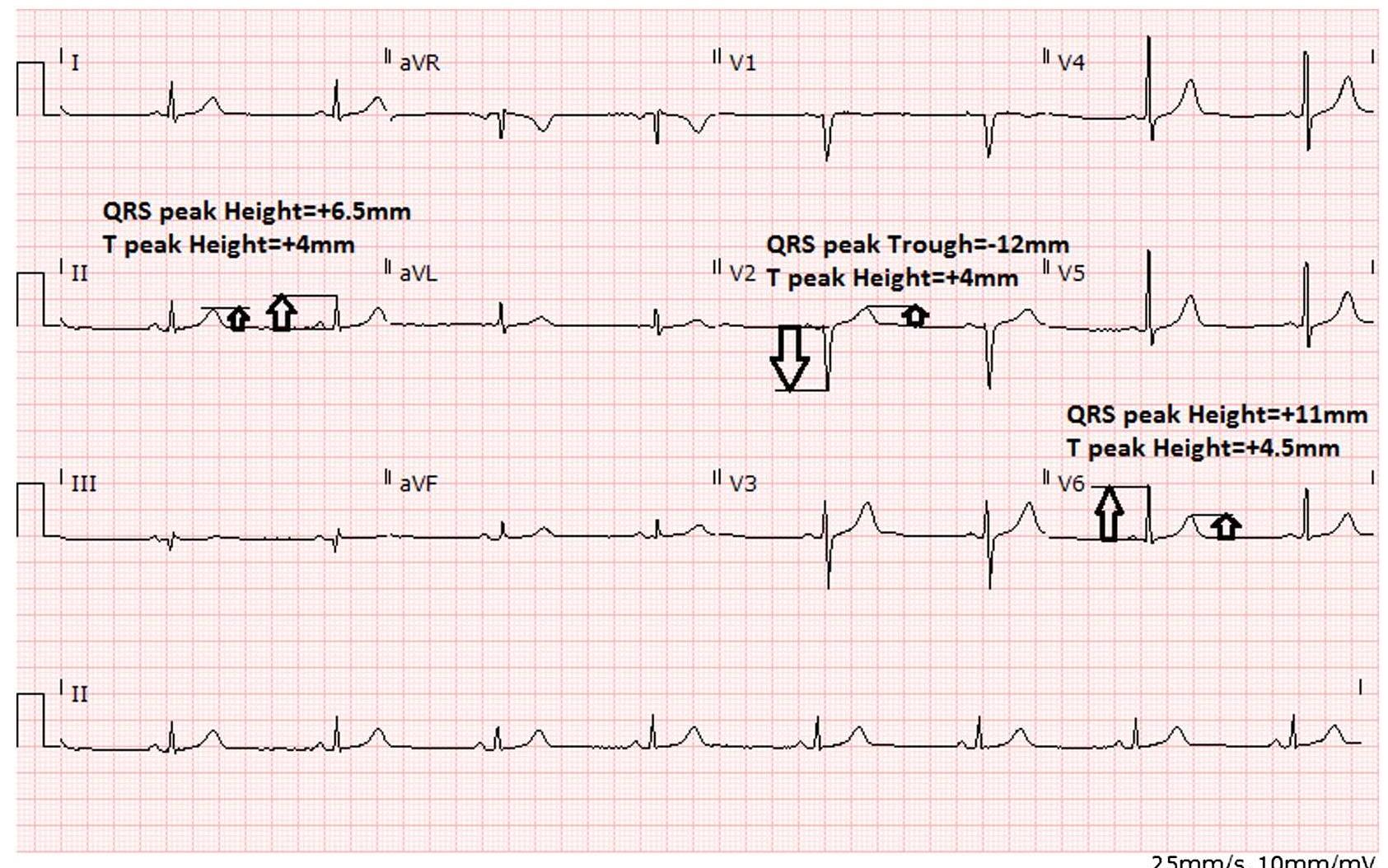 1. example electrocardiogram showing the visual estimates