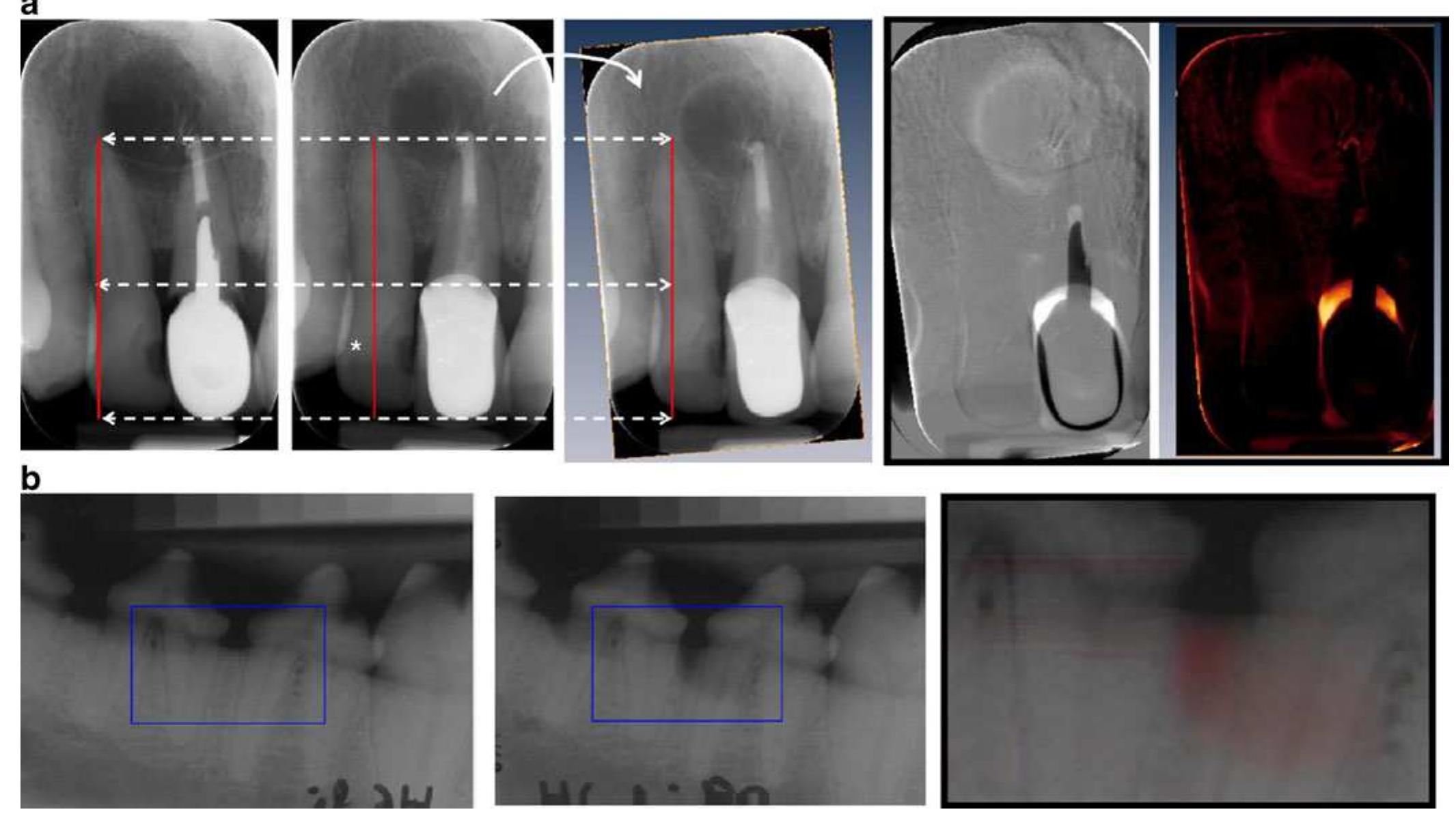 Digital subtraction radiography. (a) follow-up of a