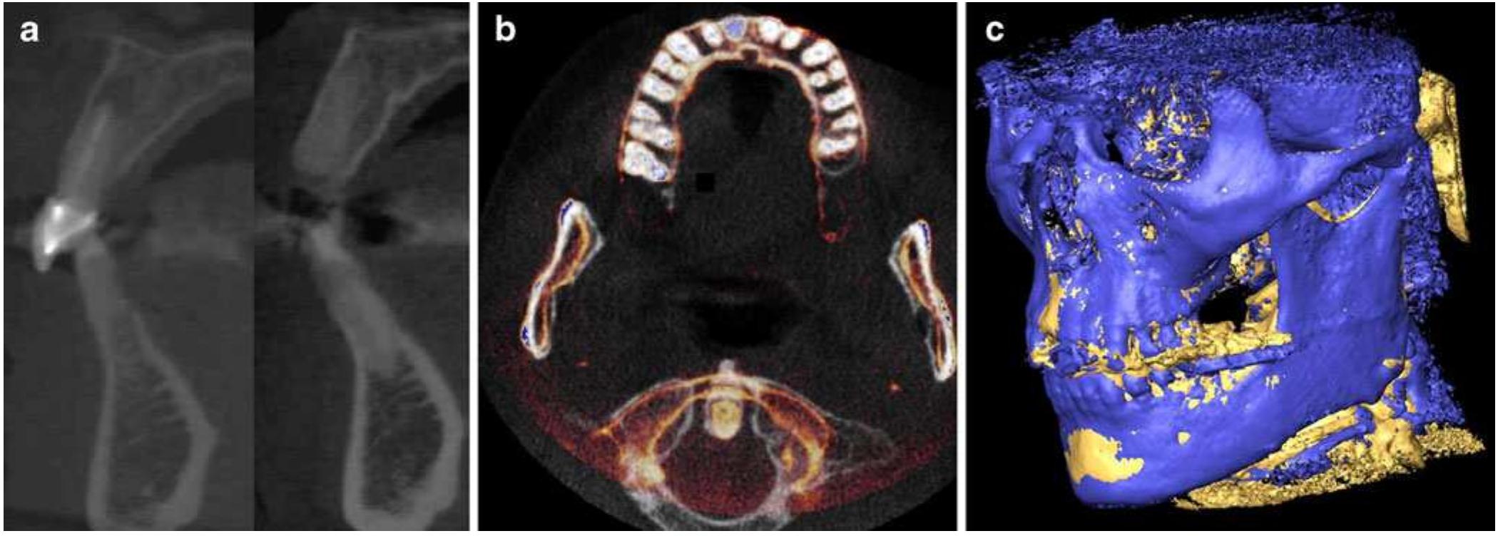 (a) sagittal cbct section through the maxillary central