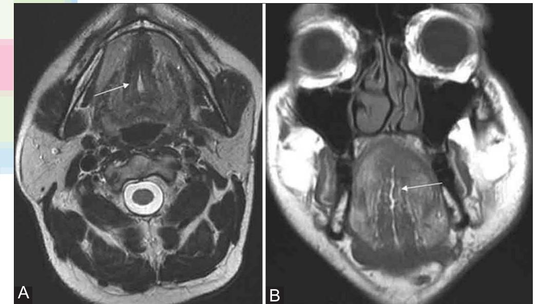 (a, b): (a) axial t2w mri showing the paired genioglossus