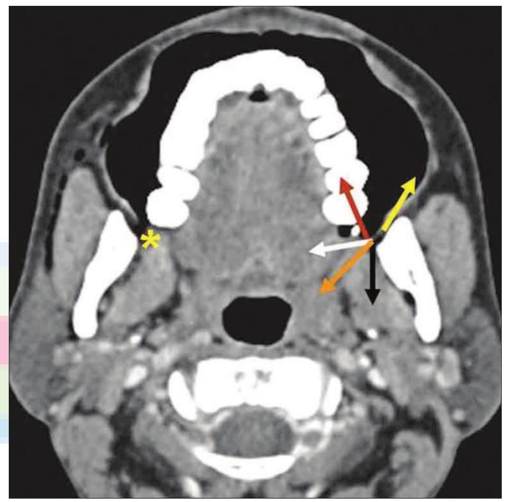 Shows possible pathways of spread of rmt cancers, buccal