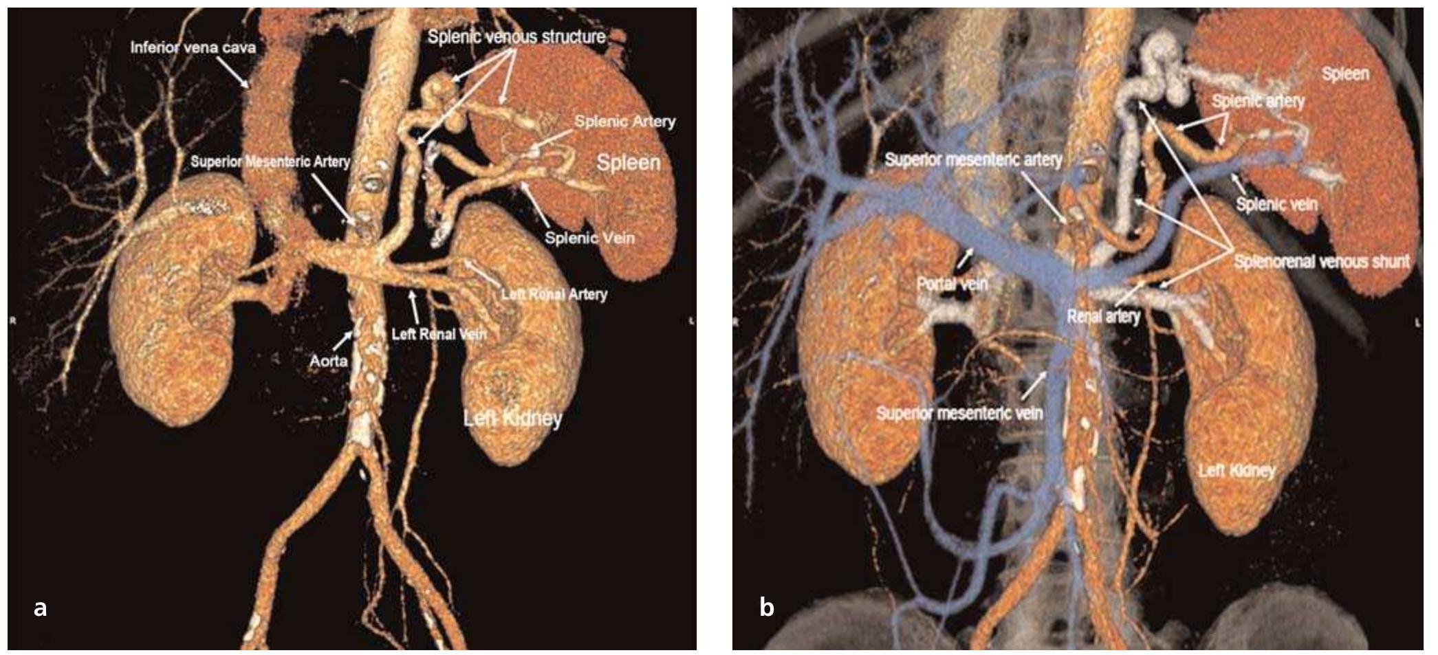 Coronal 3d mdct images. (a) splenorenal shunt: left renal