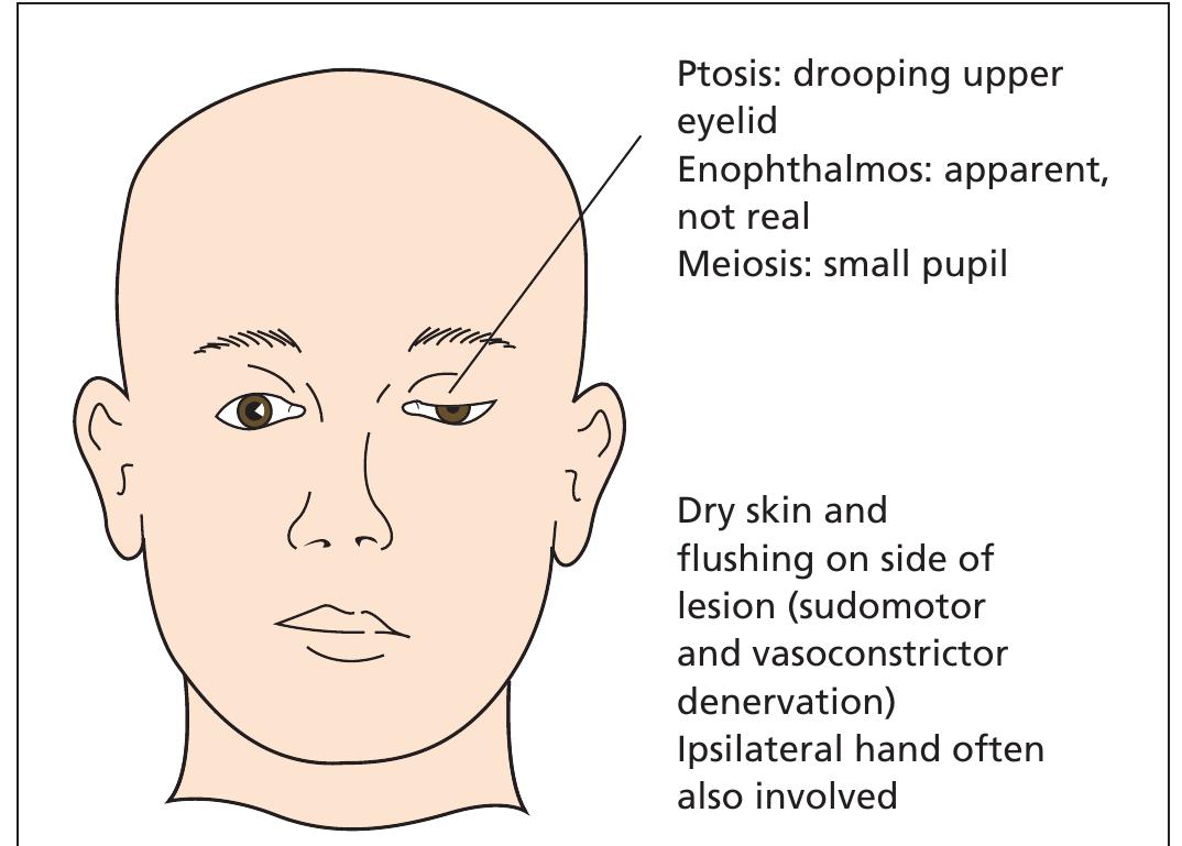 Lateral cutaneous nerve of the thigh compression: meralgia