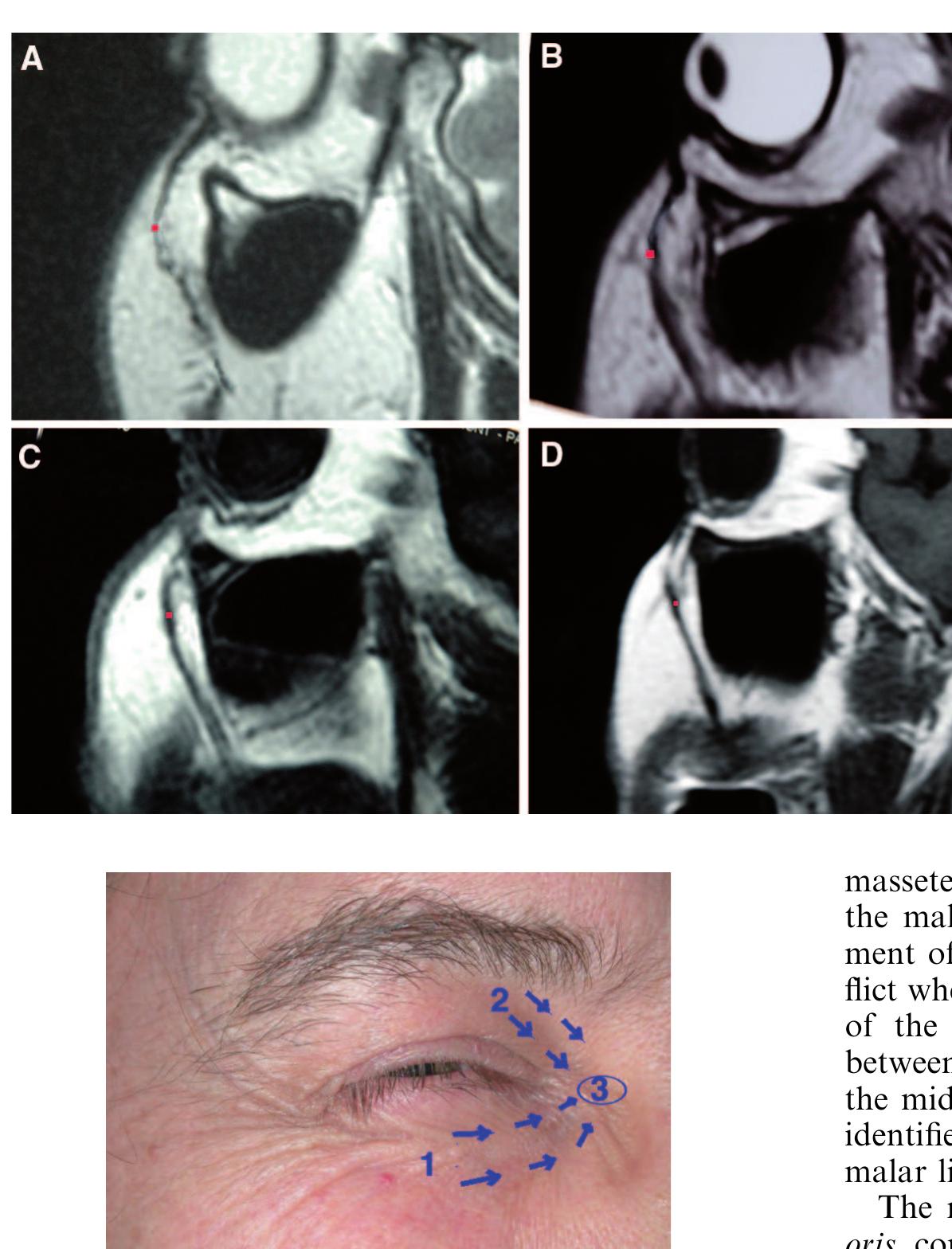 Lower eyelid in forced contraction. the superior malar part