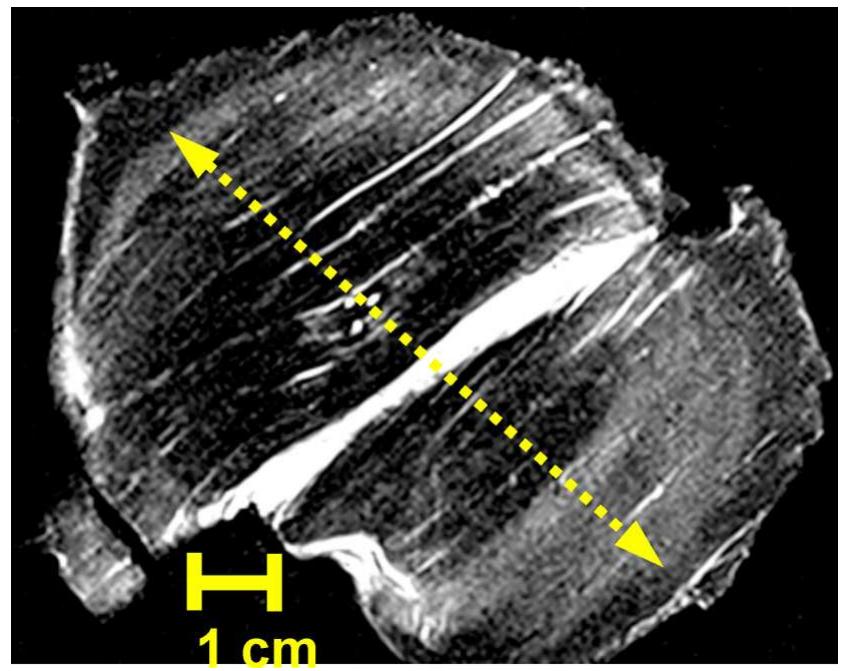 Mr image of ablation zone orthogonal to electrode axis.