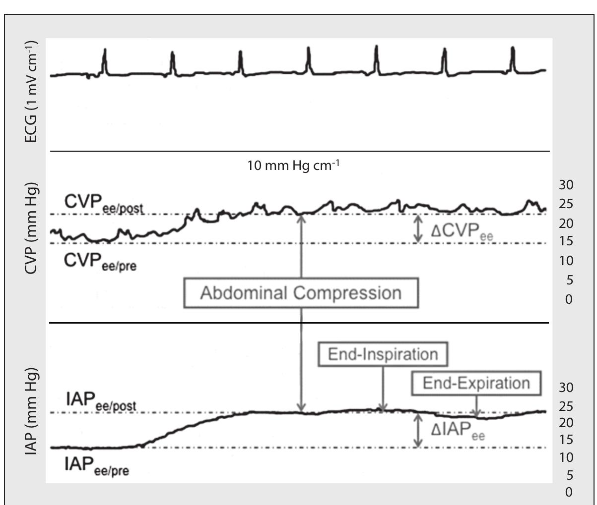 Calculation of abdomino-thoracic index (ati) of transmission
