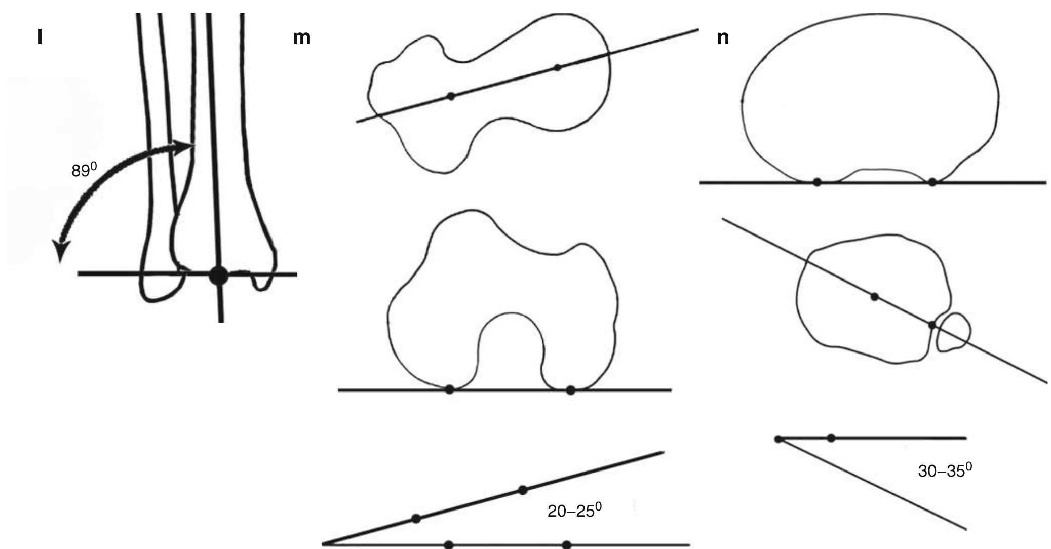 32 (continued) (1) method of distal tibial bone fragment