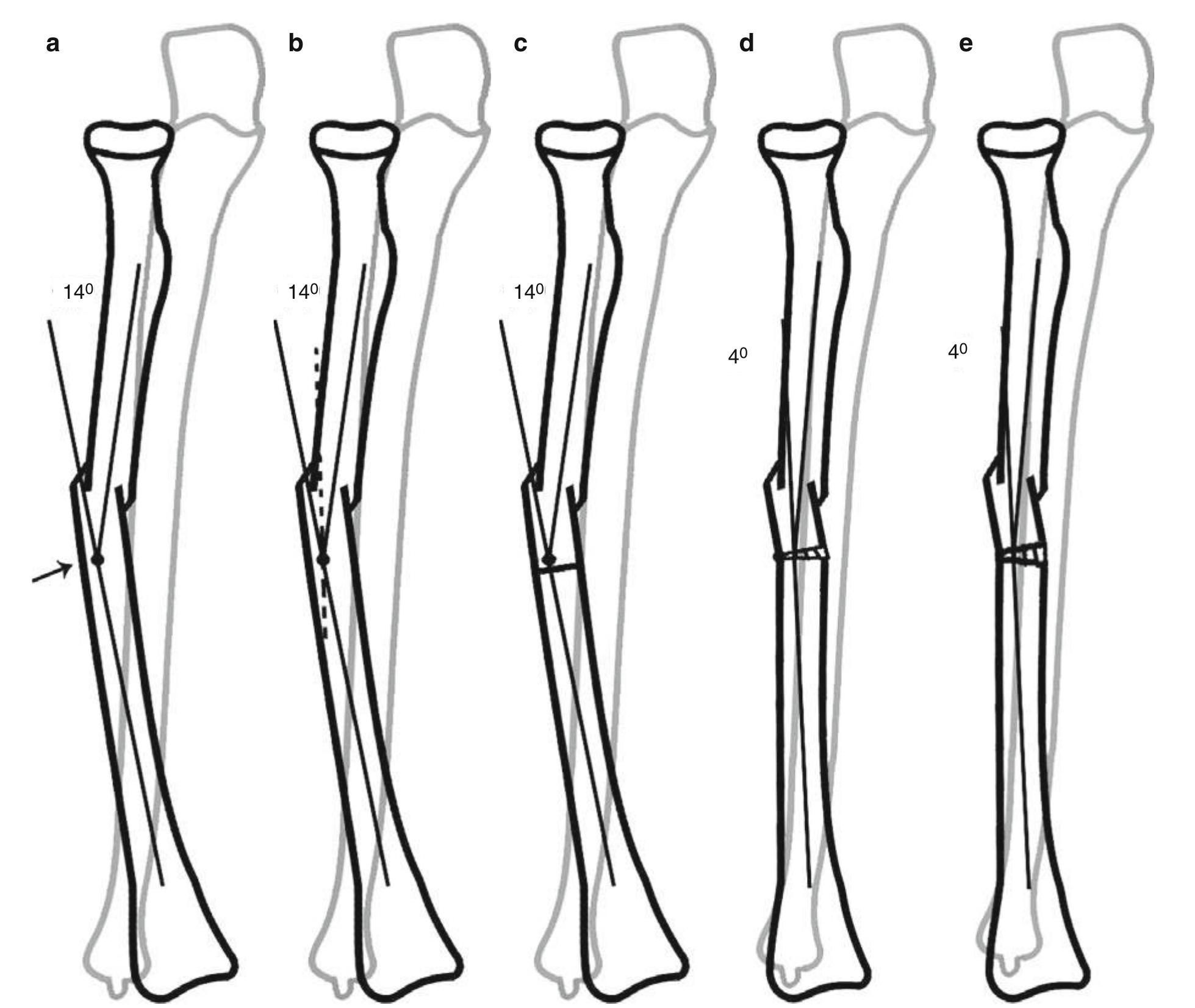 The deformity is shown. (c) the osteotomy line (at the level