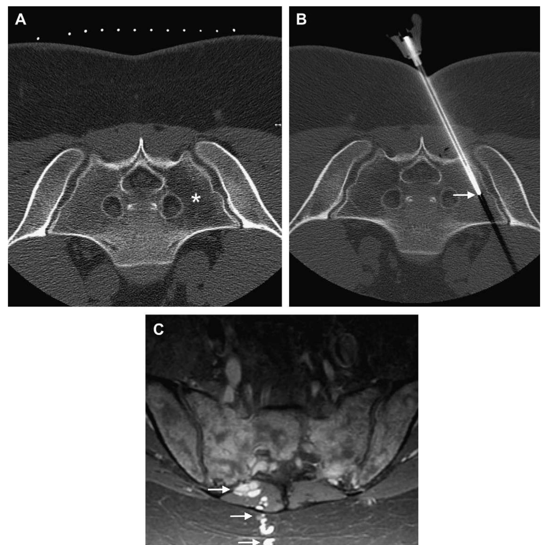 (a) prone axial ct image through the sacrum in a 29-year-old