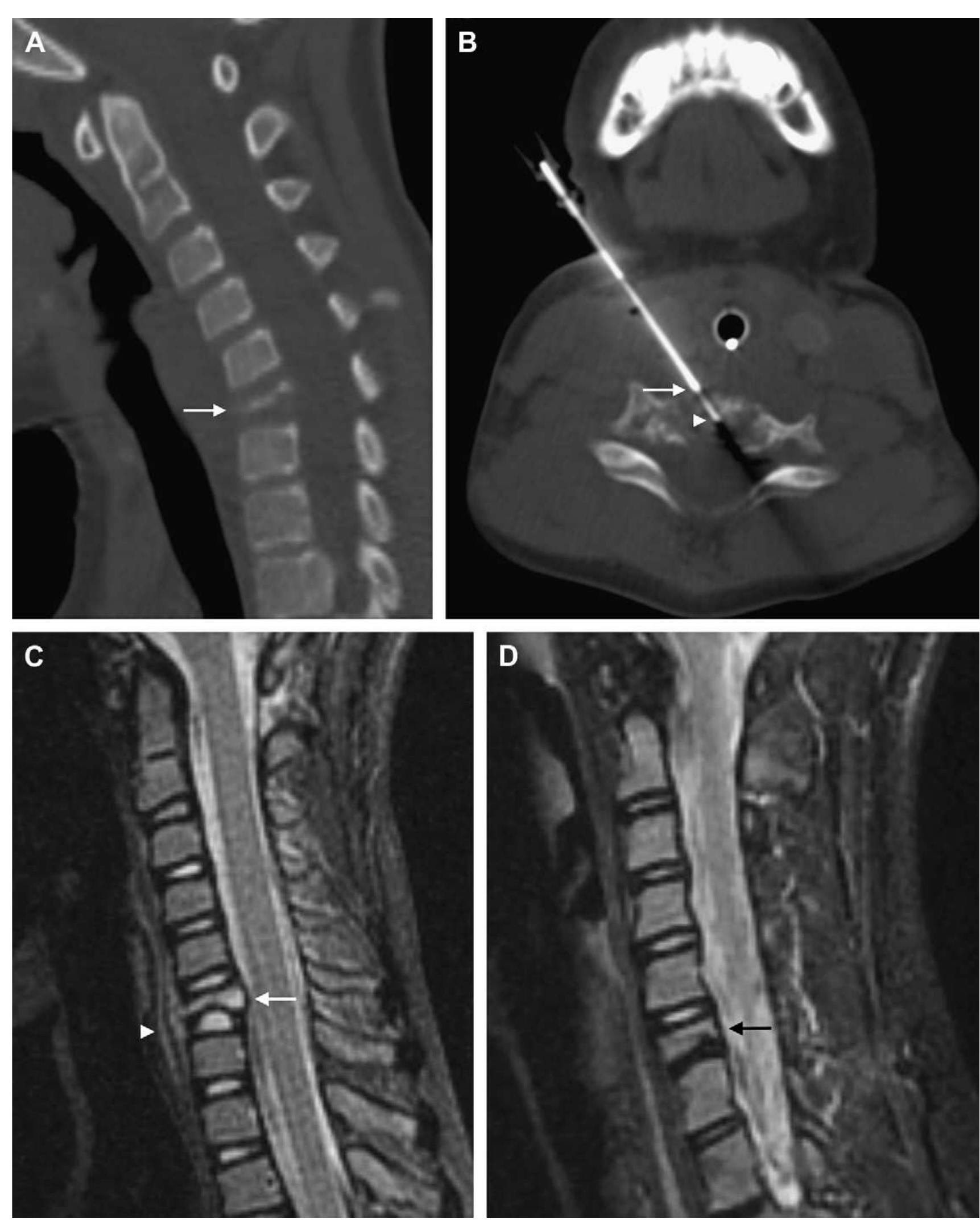 (a) sagittal reformatted ct image of the cervical spine in a