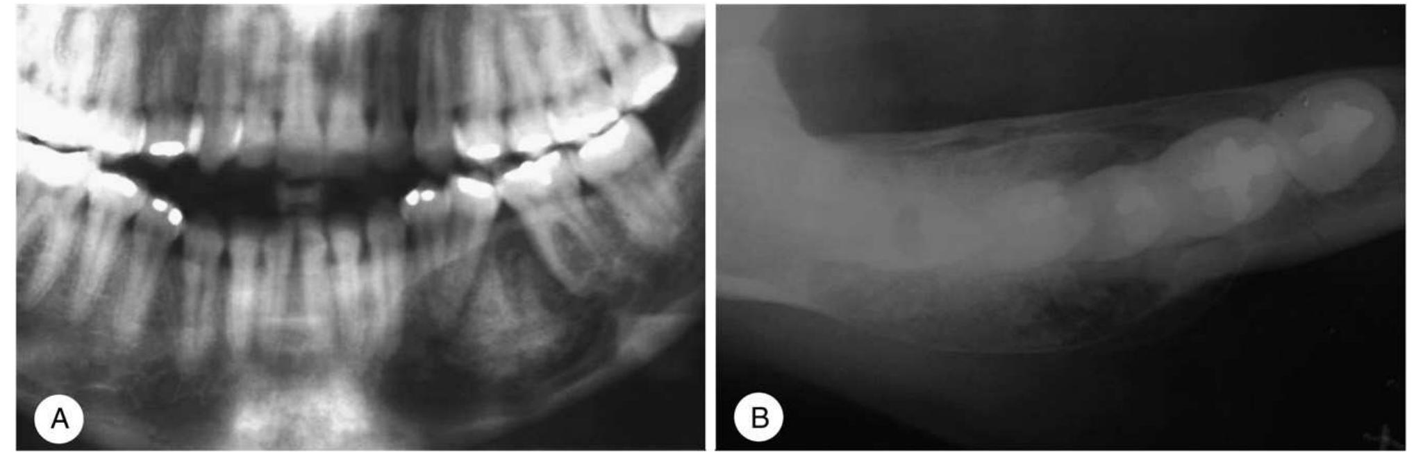 Panorex (a) and occlusal (b) radiographs of cgcot showing a
