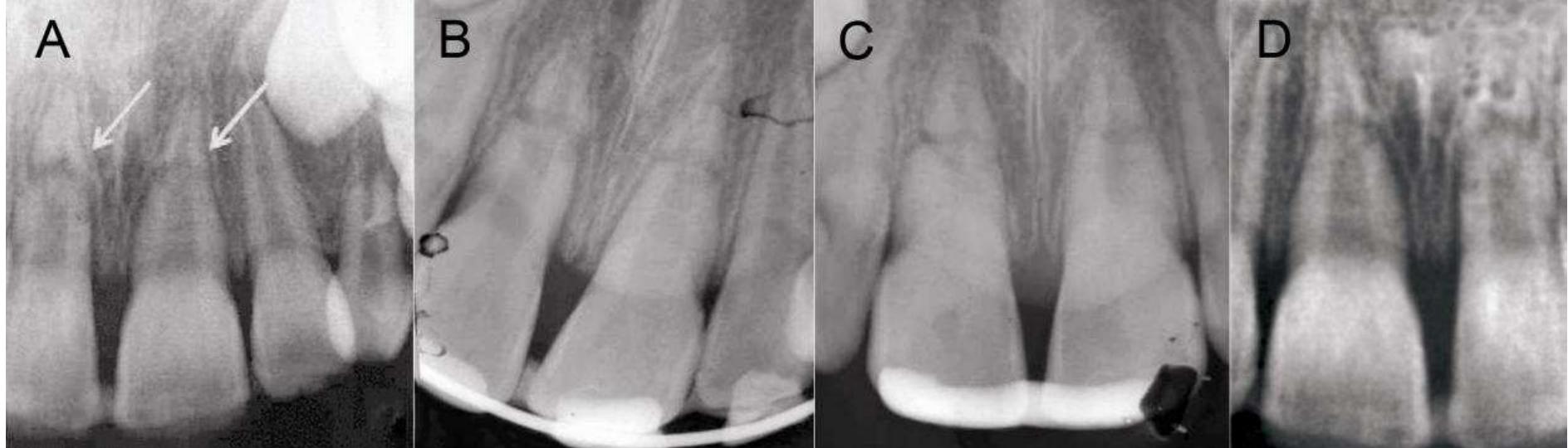 A: periapical radiograph showing horizontal root fractures