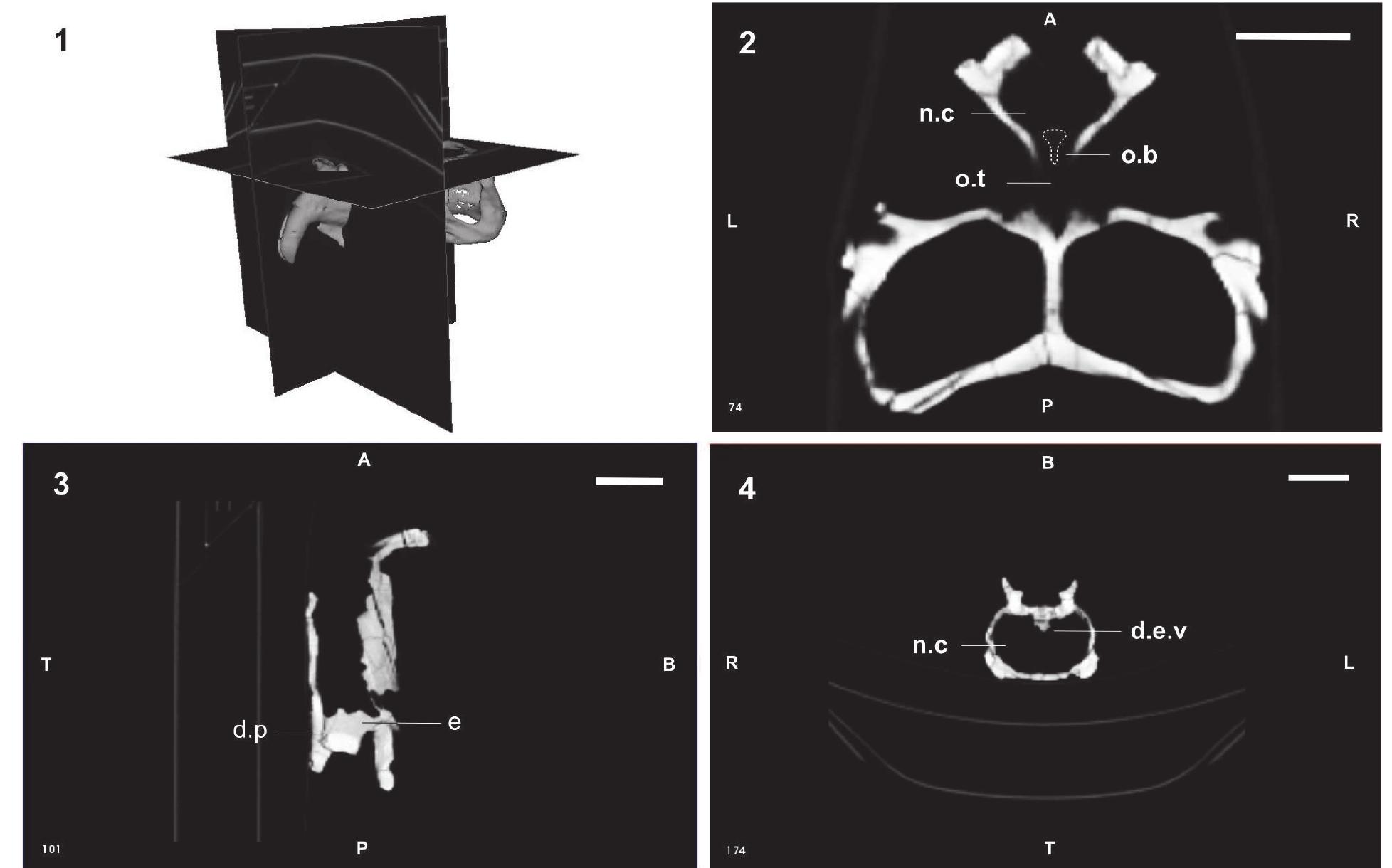 Ct slices and digital reconstruction of the skull of