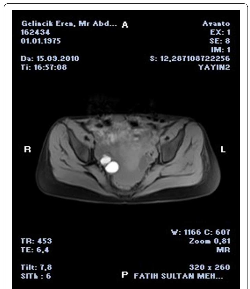 Figure 1 - from The intraabdominal bleeding with an inguinal