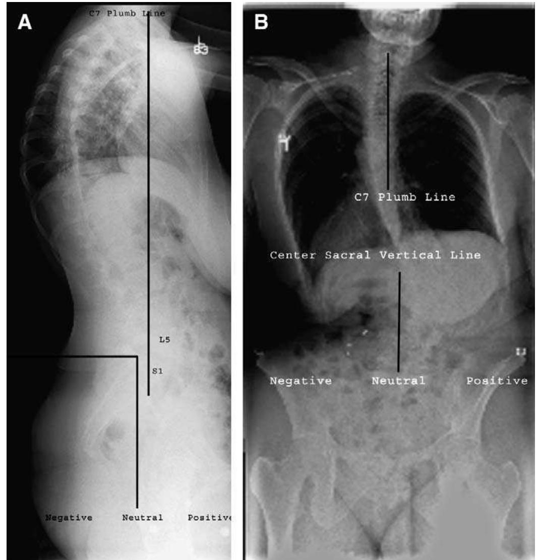 Figure 3 - from Degenerative Lumbar Scoliosis