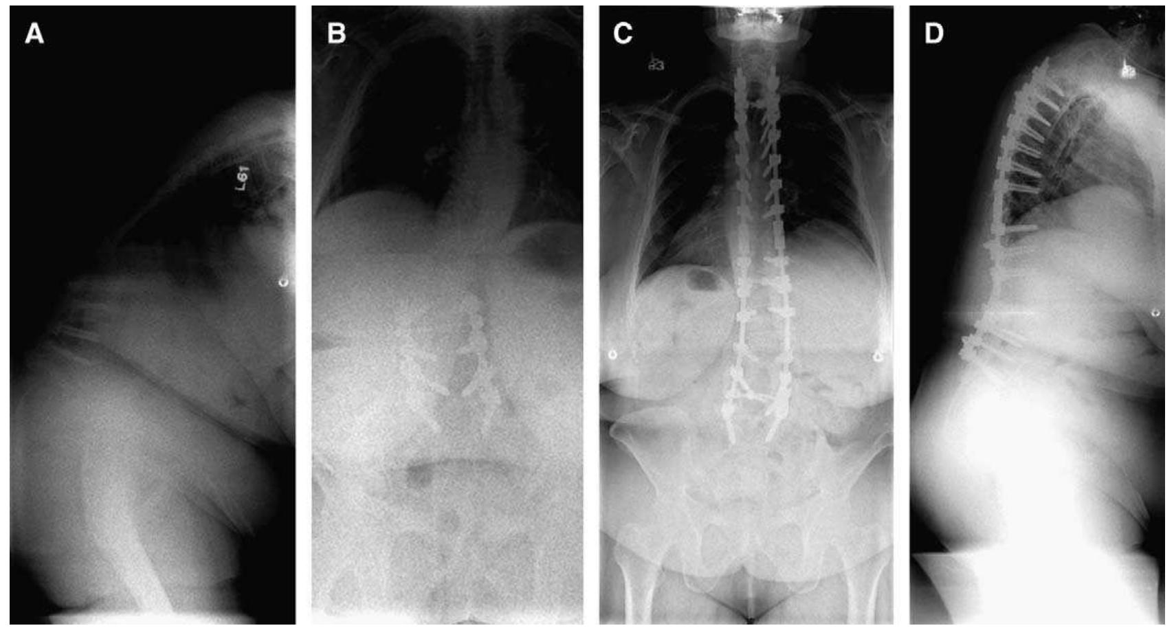 Fixed sagittal plane deformity is one of the more