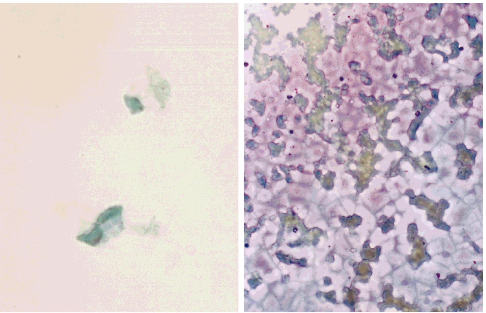 (a) colloid material aspirated from a colloid nodule