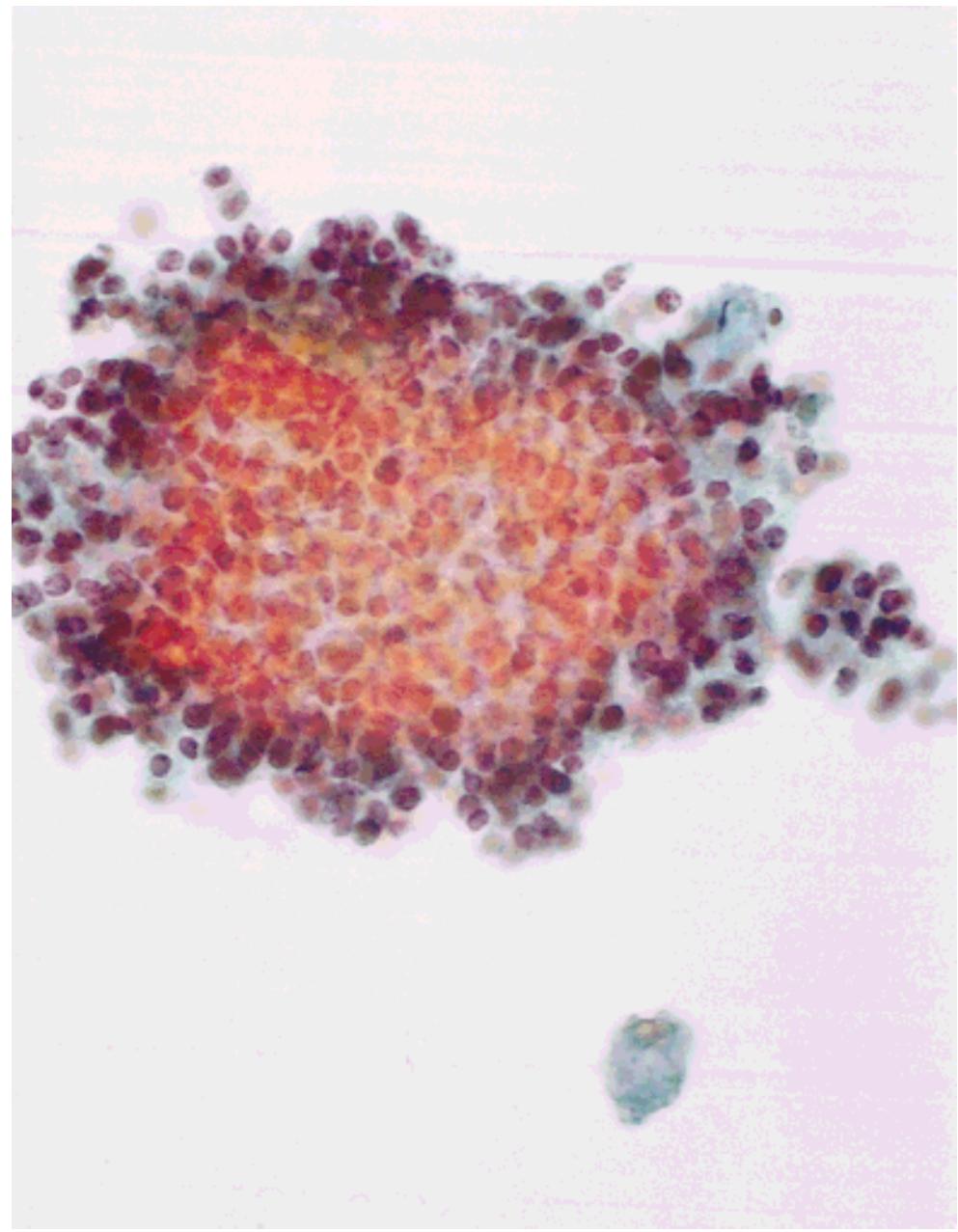 Sample prepared by the thinprep process showing loss of